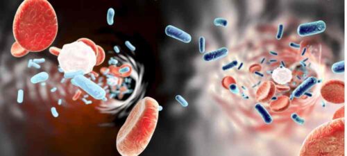 What is Sepsis? - End Sepsis